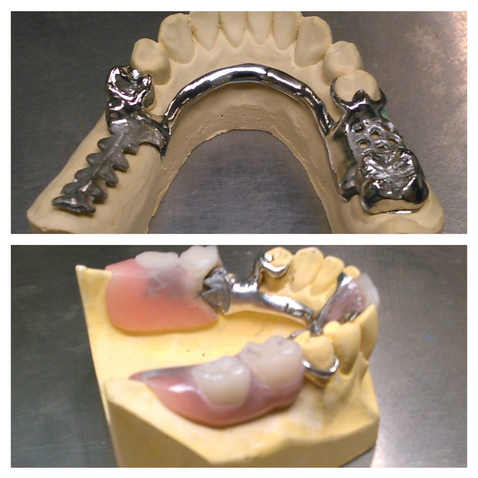 A removable partial denture can replace many missing teeth at a lower ...