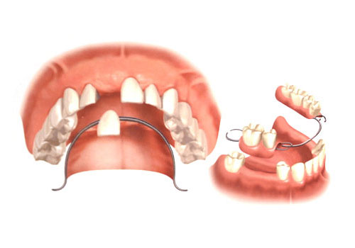 Removable Partial Dentures; Prosthodontics
