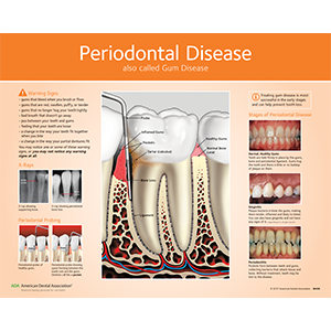 How Periodontal Disease Affects the Body