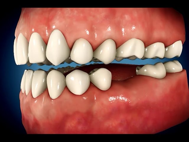 Restorative Dentistry: Single-Tooth Atrophy
